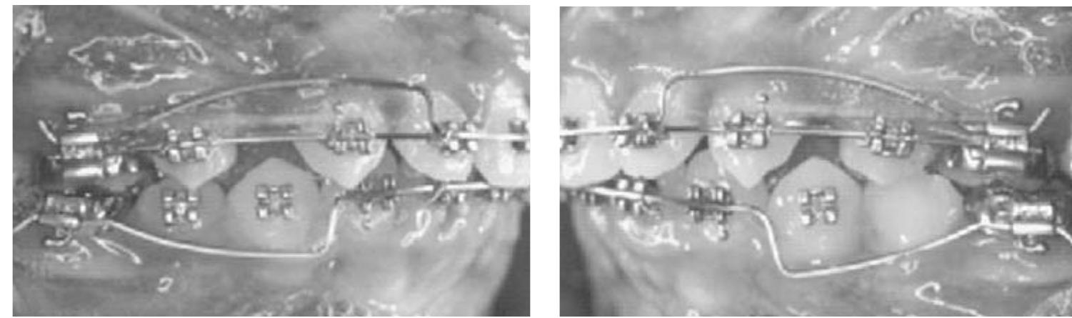A: canine retraction with .016" x .022" stainless steel base