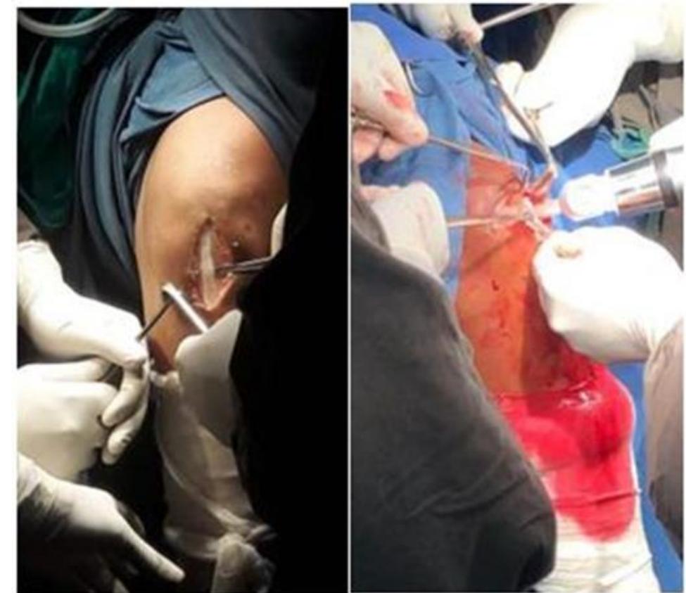 Harvesting the patellar tendon bone graft