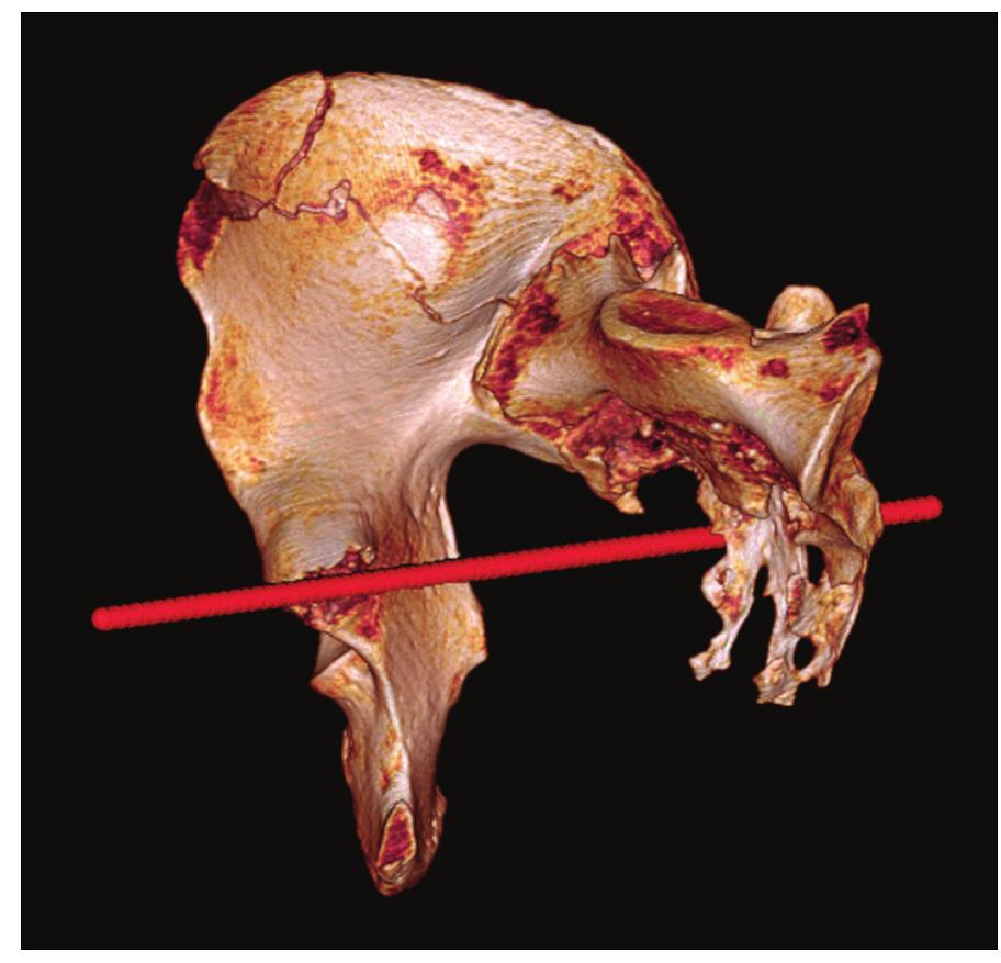 Reconstructed right hemi-pelvis and sacrum post-mortem ct
