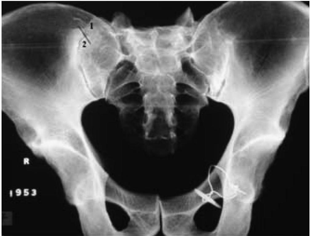 Radiograph of pelvis with right (r) sacroiliac joint