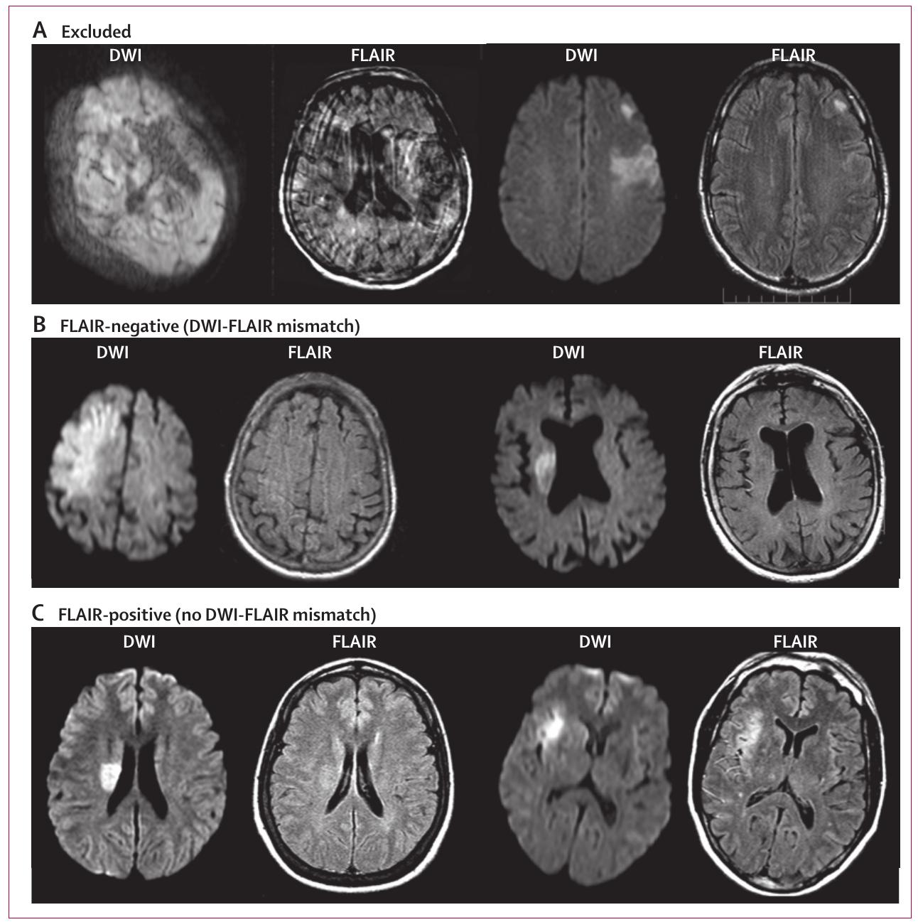 Examples of dwi and flair images (a) diffusion-weighted