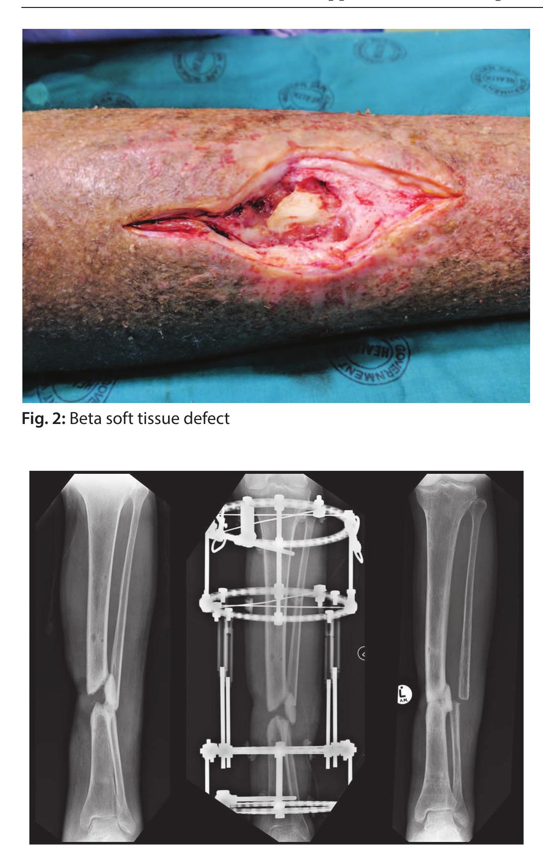 Gradual shortening with circular external fixator