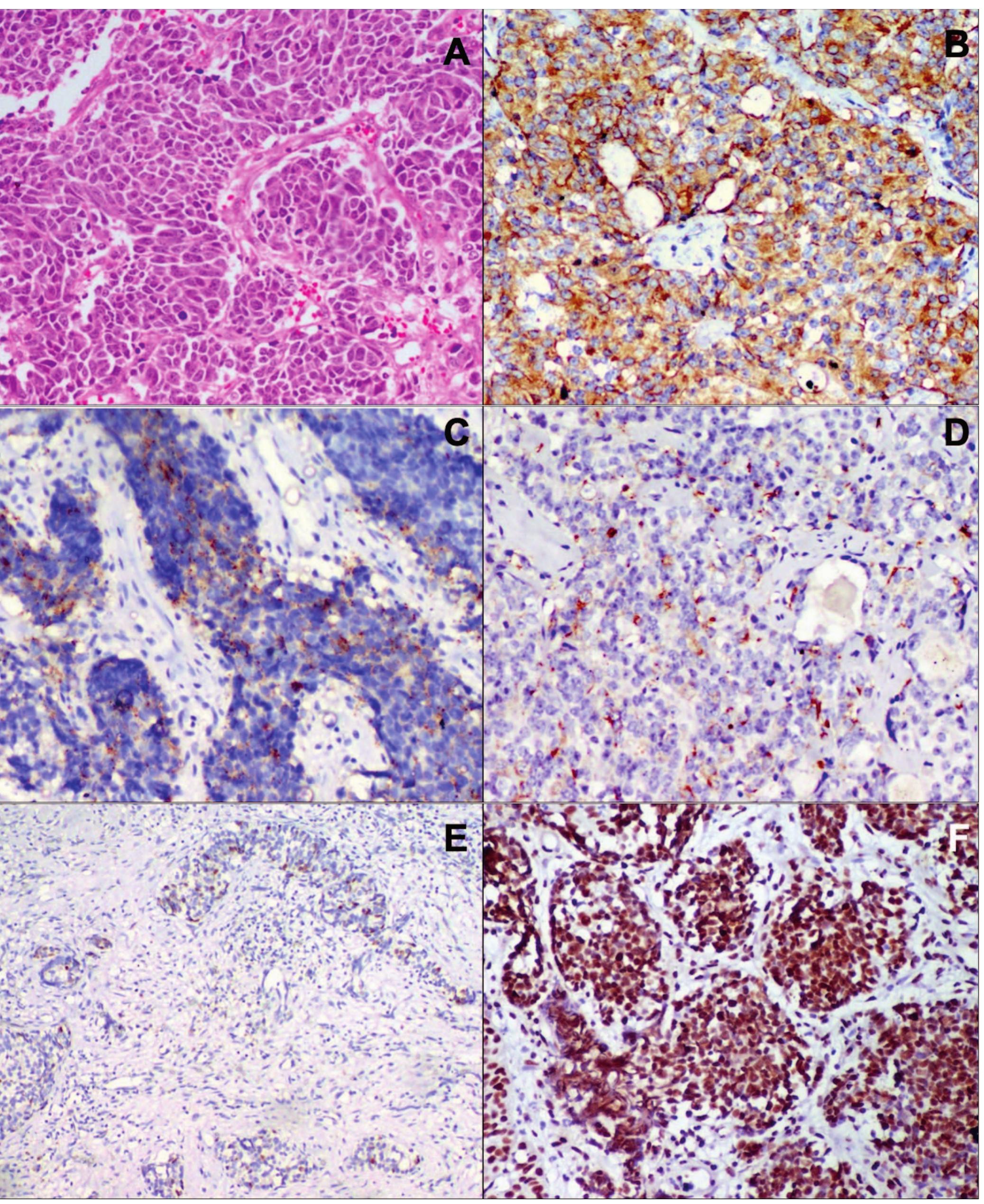 Large cell neuroendocrine carcinoma showing tumor cells with