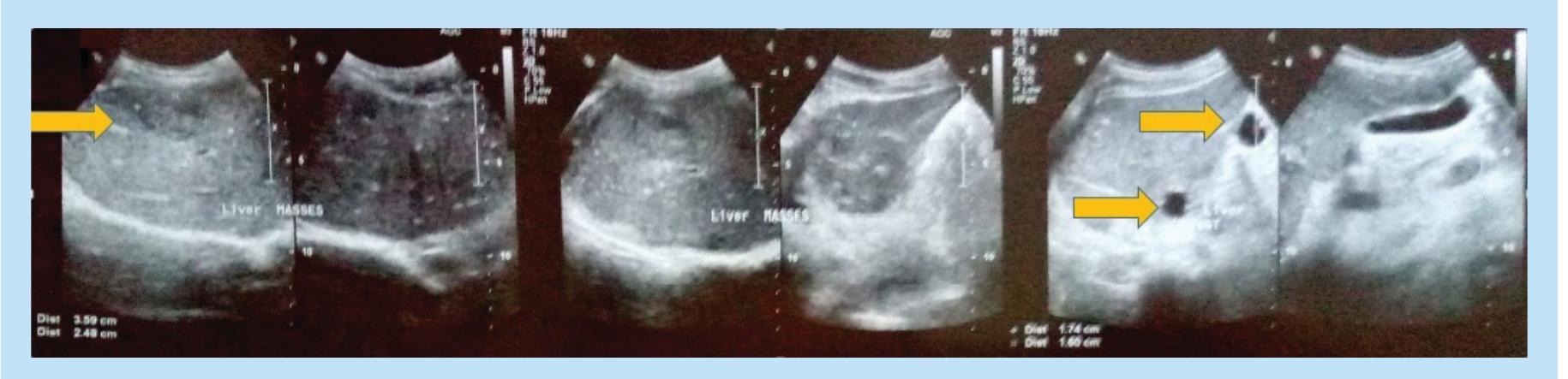 Ultrasonography showing multiple hepatic lesions after two