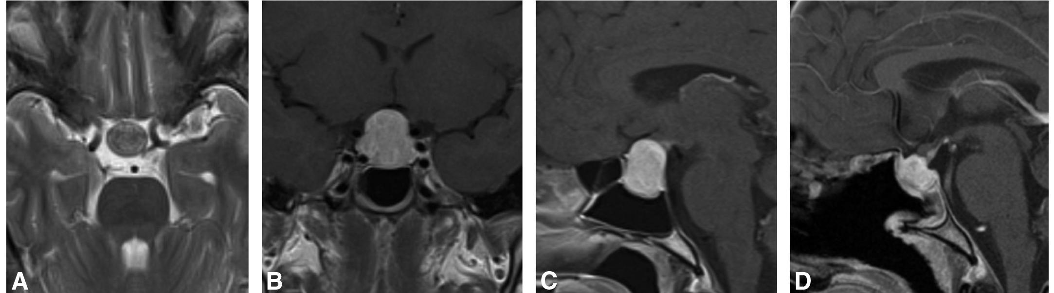 Lymphocytic hypophysitis. axial t2wi (a) and coronal (b) and