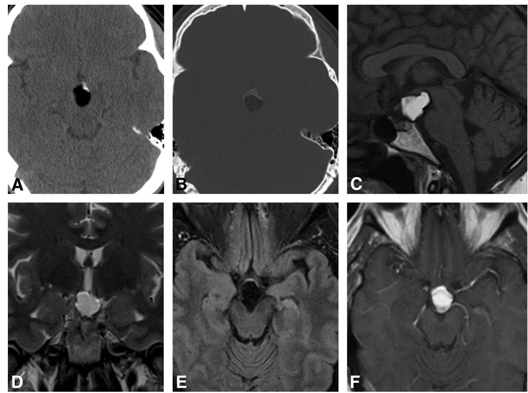 Dermoid cyst. axial soft-tissue (a) and bone (b) algorithm