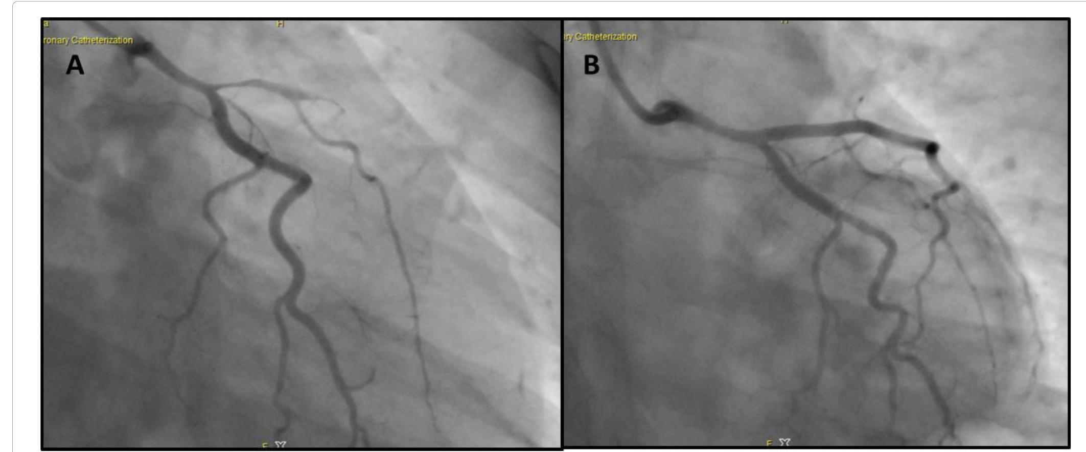 First coronary angiography: anteroposterior view revealed