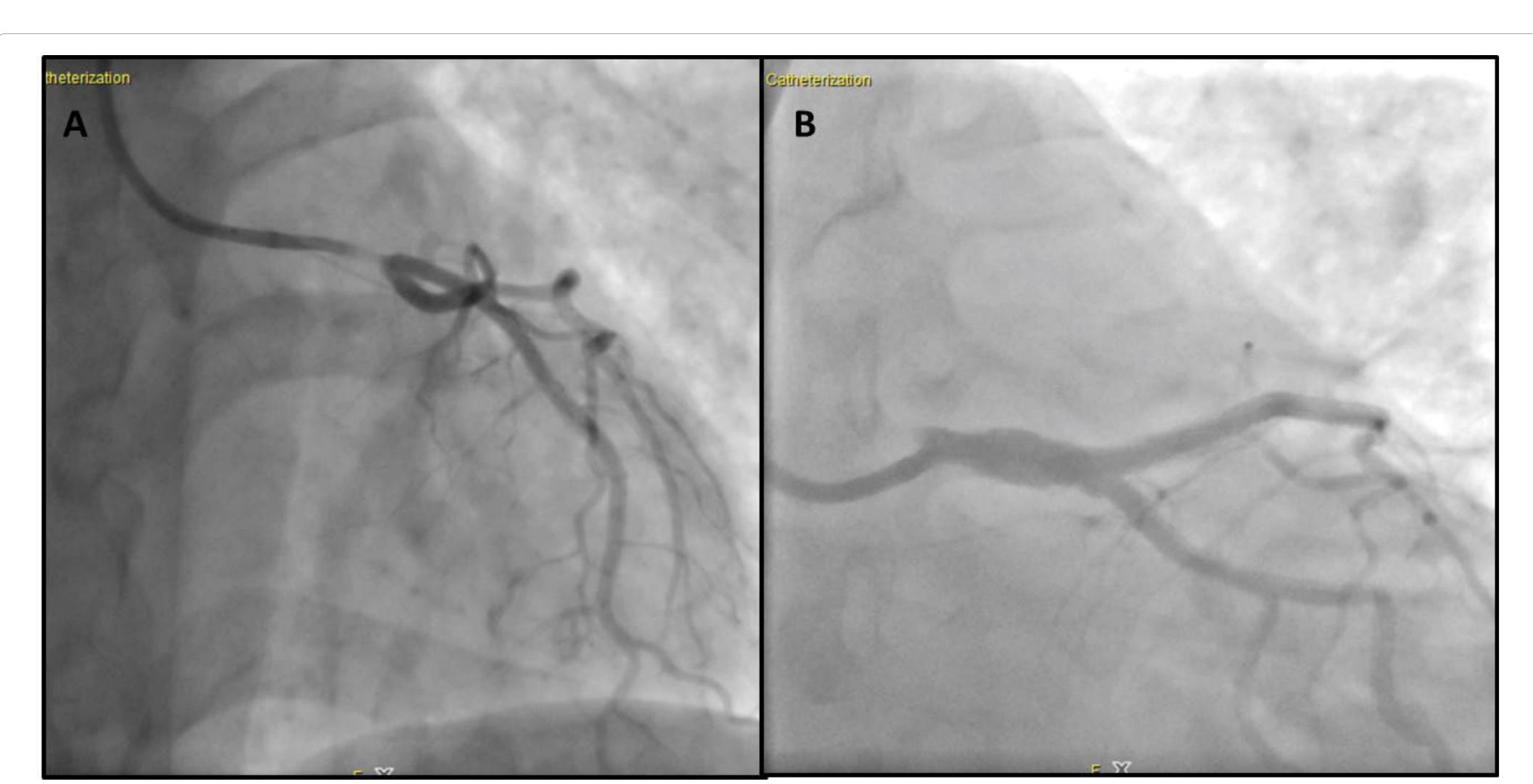 Second coronary angiography: left anterior oblique view