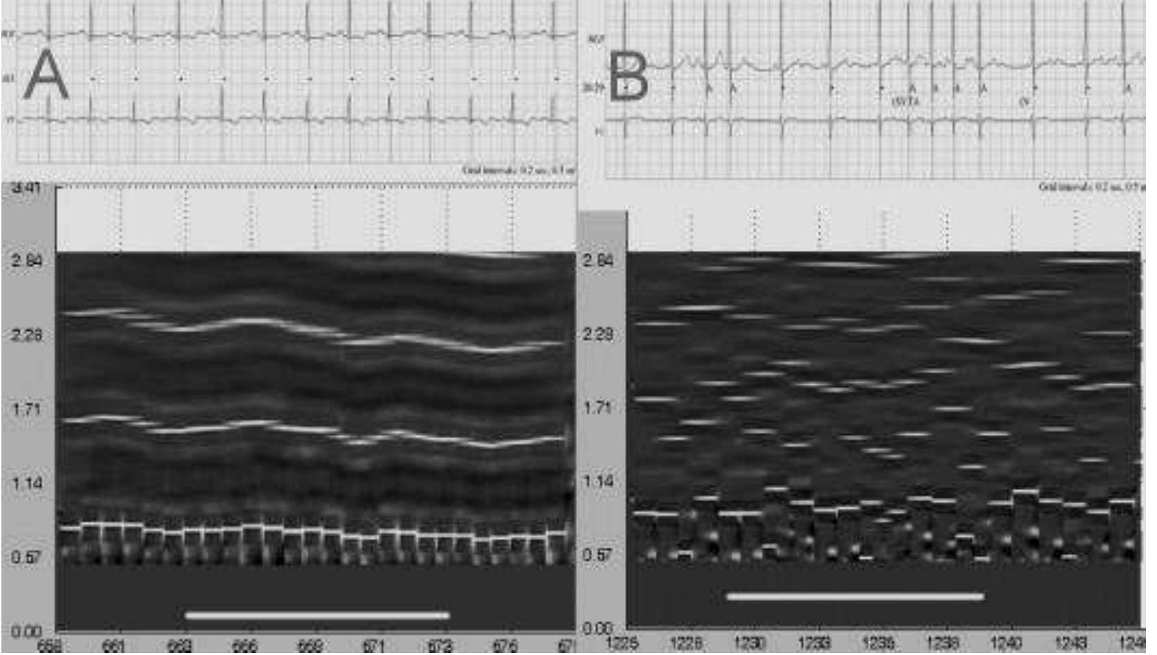 2-d graphical representations for ecg. a — normal sinus