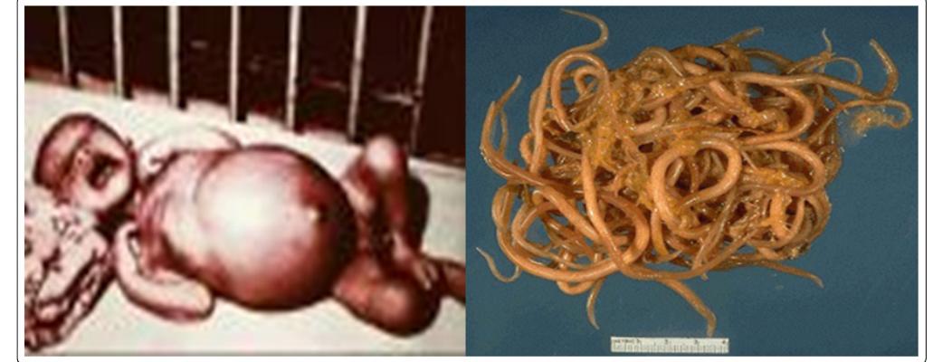 According to world health organization, the soil-transmitted