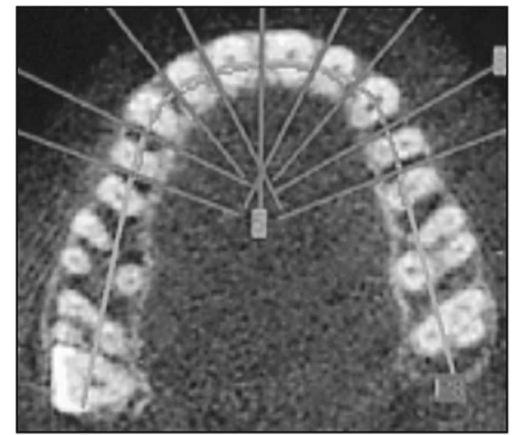 In the anterior maxillary arch, from right first premolar to