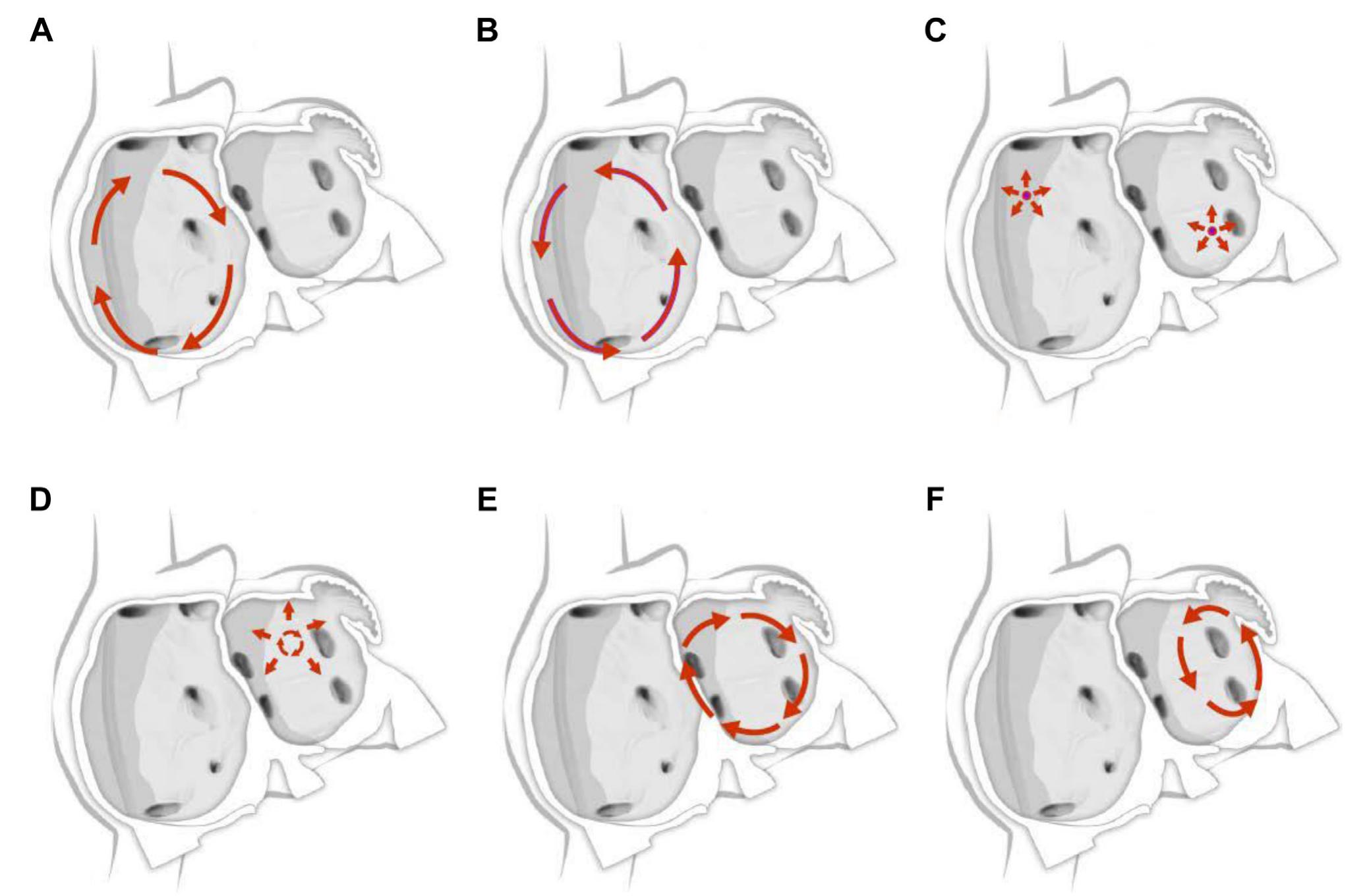 Schematic drawing showing mechanisms of atrial flutter and