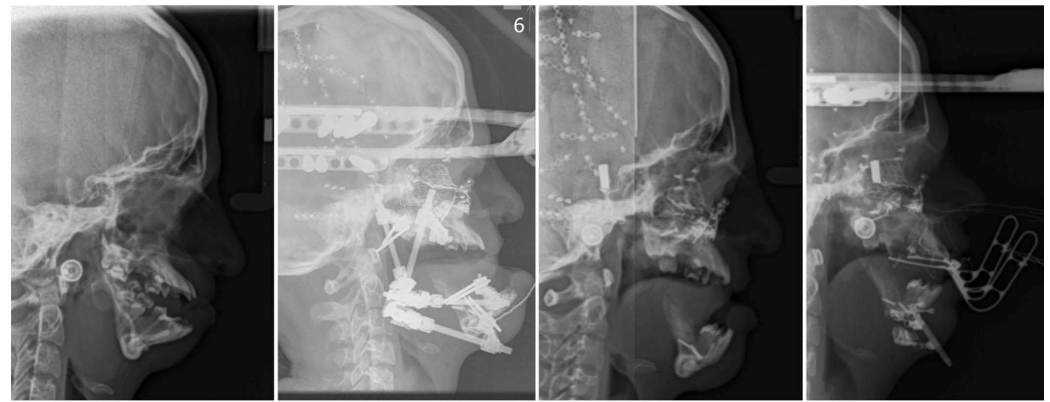 Cephalometric radiographs showing the basic steps of