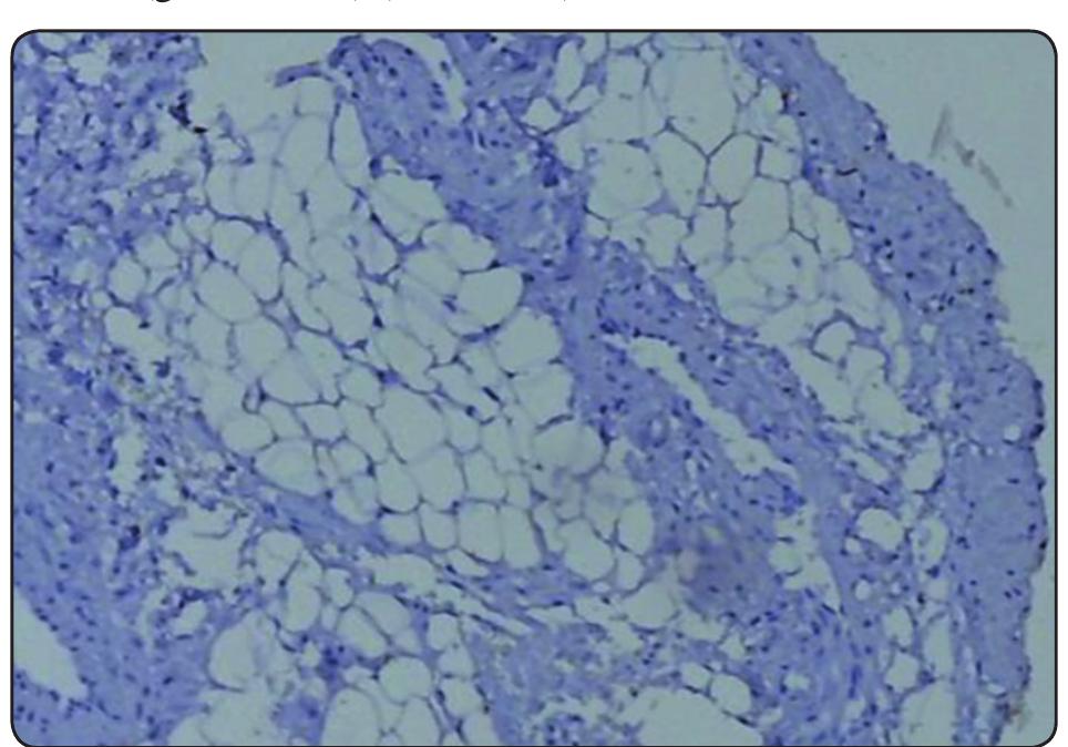 (10): a photomicrograph of connective tissue graft following