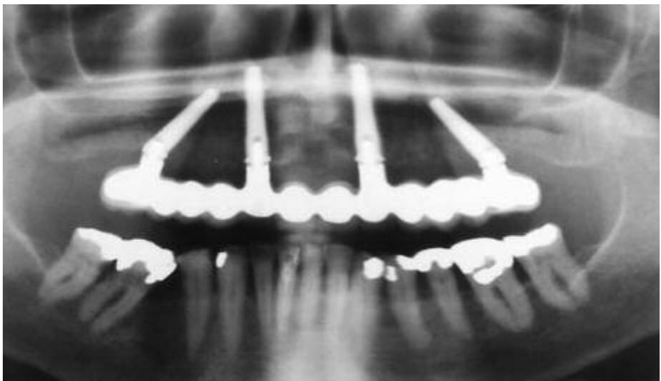 Panoramic radiograph showing distal angulation of the