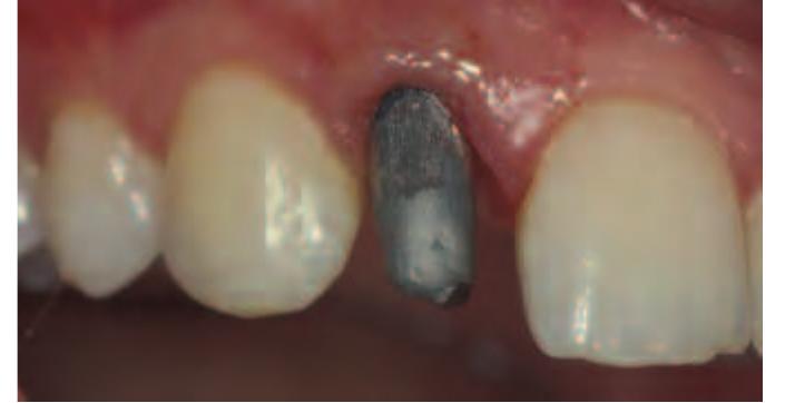 The definitive restoration on the right lateral incisor