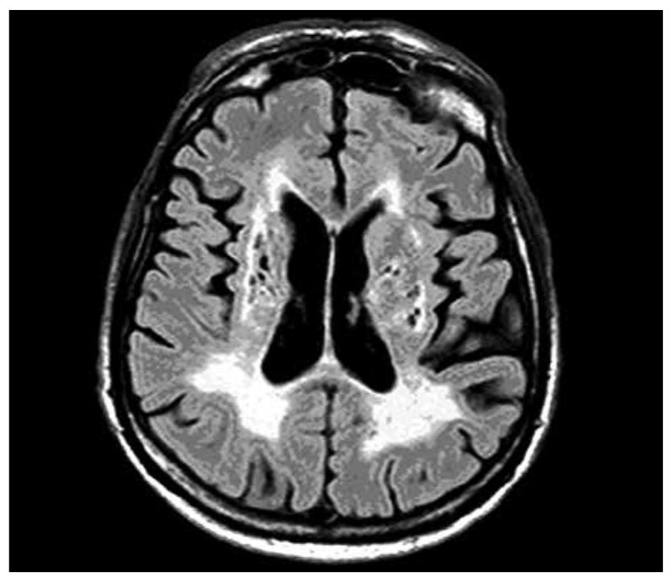 Brain mri. flair sequence showing a con- fluent lesion in