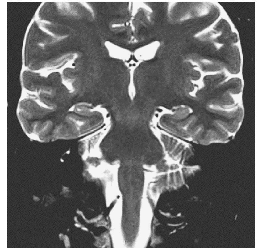 12 tirmincoronal section on the brain stem revealing a
