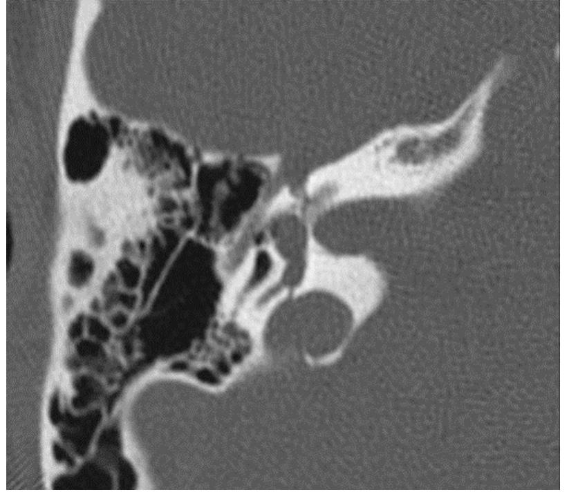 Transverse fracture of the petrosal bone passing by the