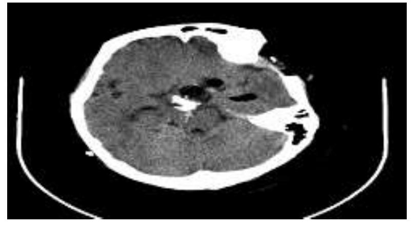 (b): sample abnormal case showing calcification in the ct