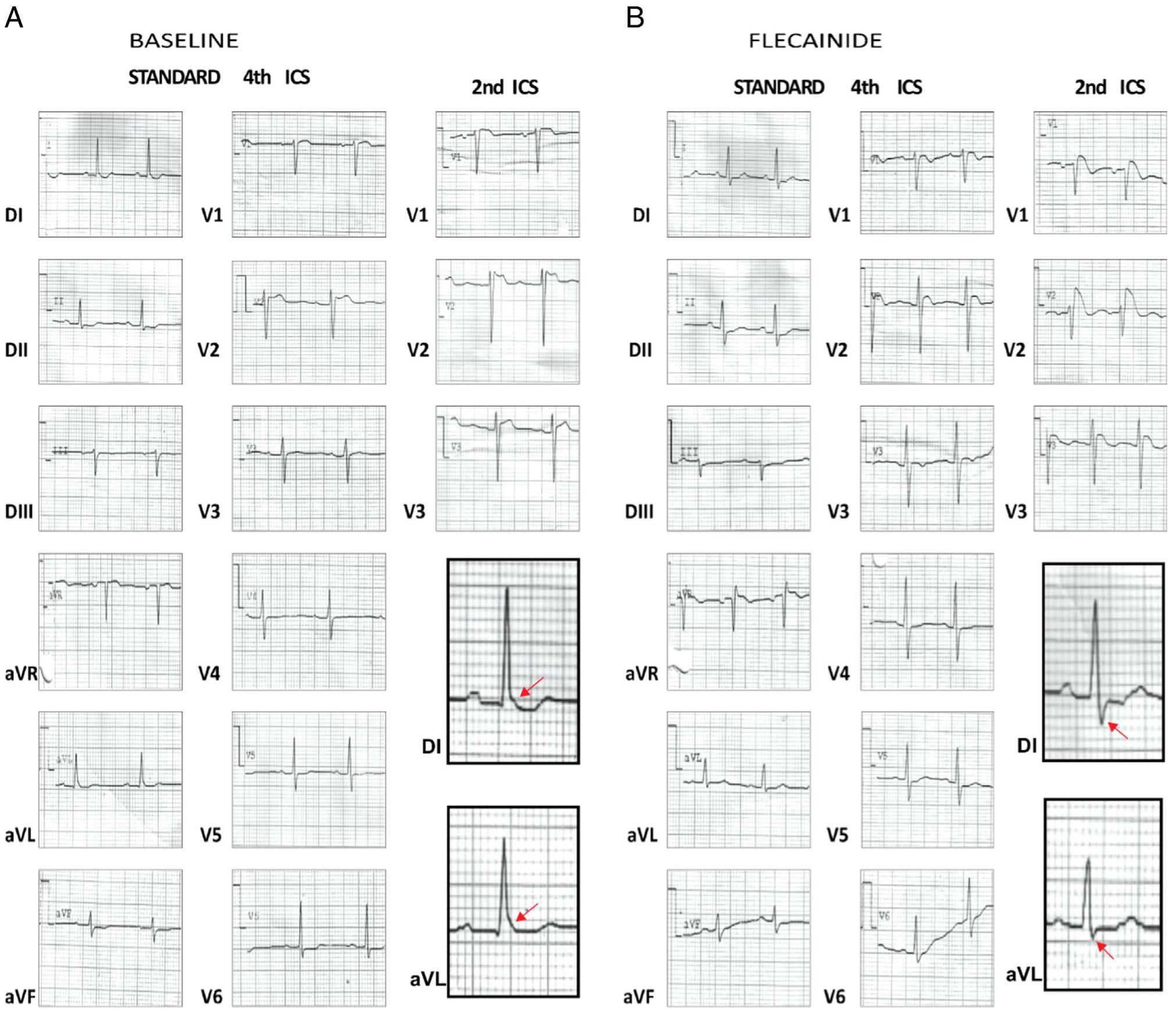 A: twelve-lead electrocardiogram (ecg) tracings baseline: