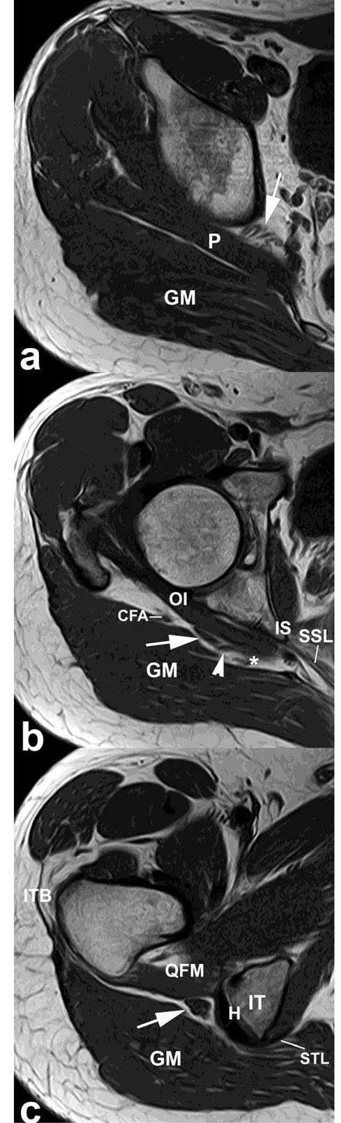 Normal anatomy of the subgluteal space. consecutive axial