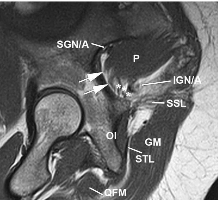 Normal anatomy of the subgluteal space. sagittal-oblique t1-
