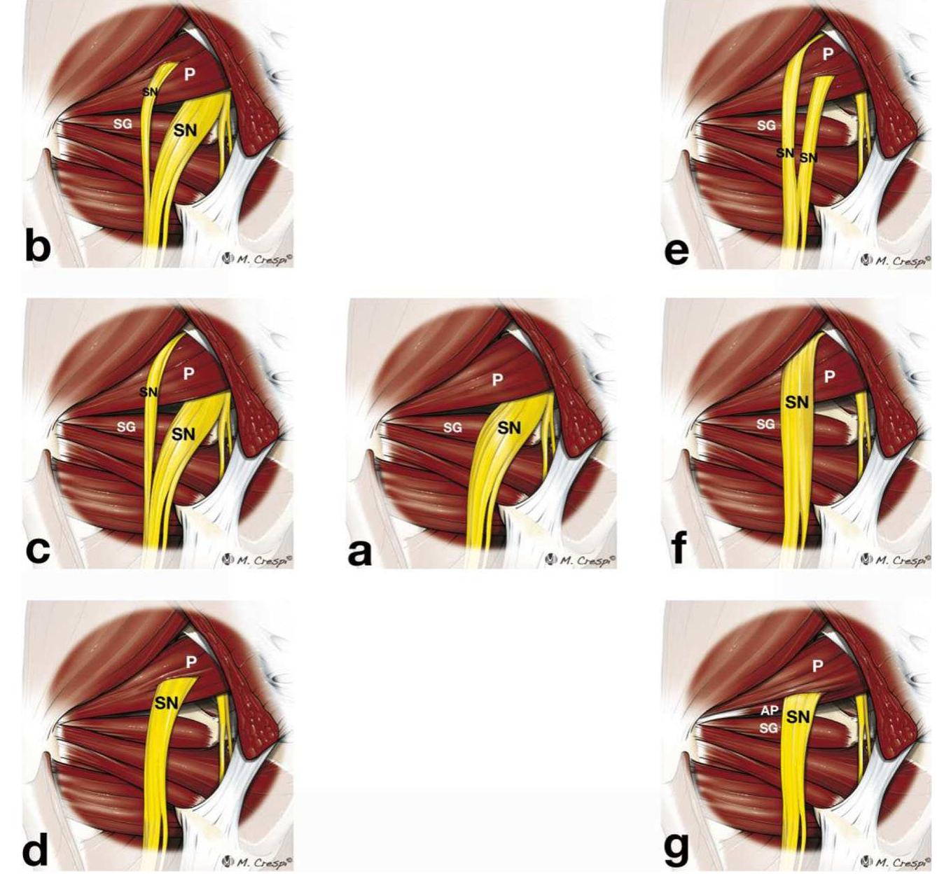 Dynamic entrapment of the sciatic nerve by the piriformis