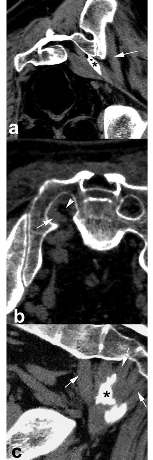Anomalous attachments of the piriformis muscle. (a)