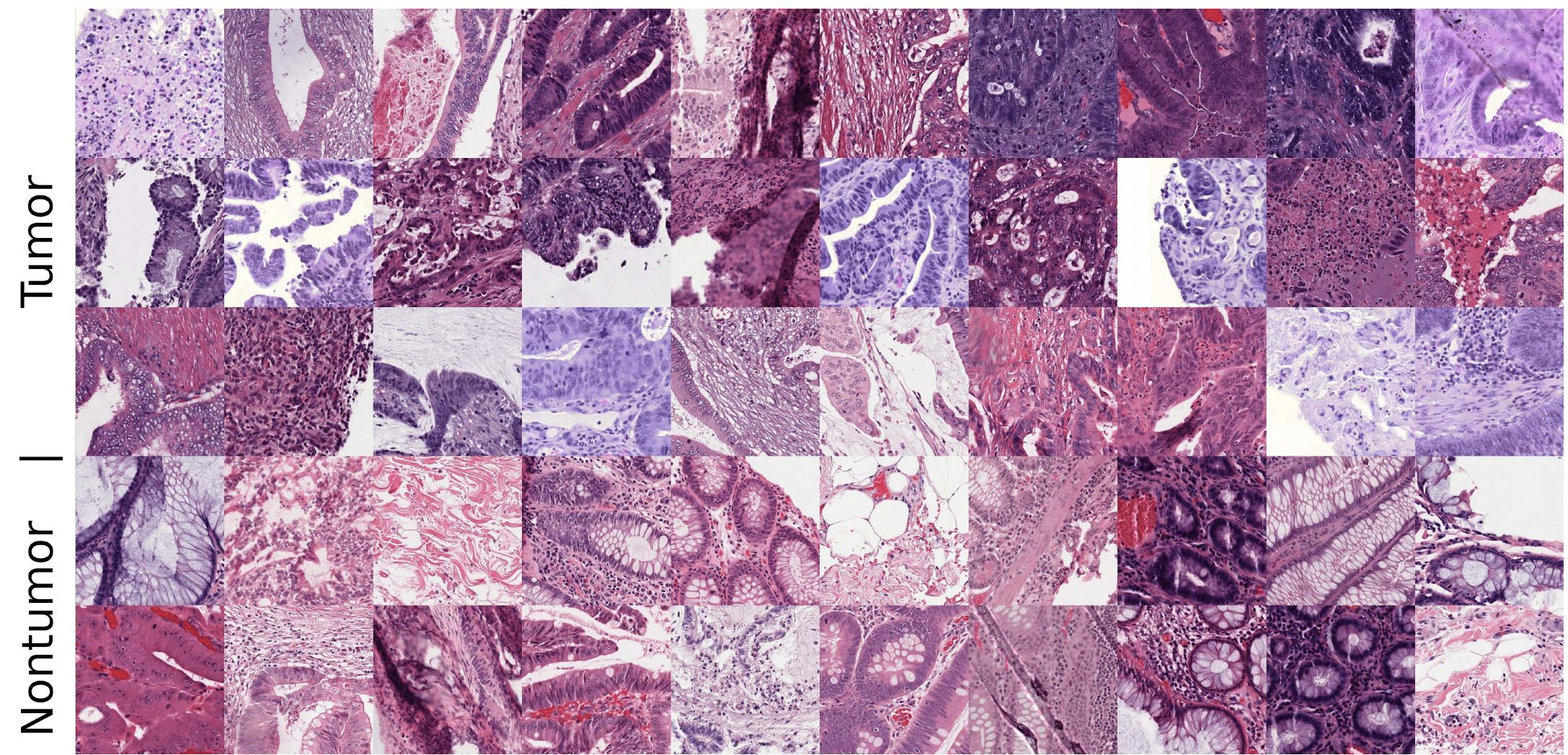 Sample tumor (first three rows) and non-tumor (last two