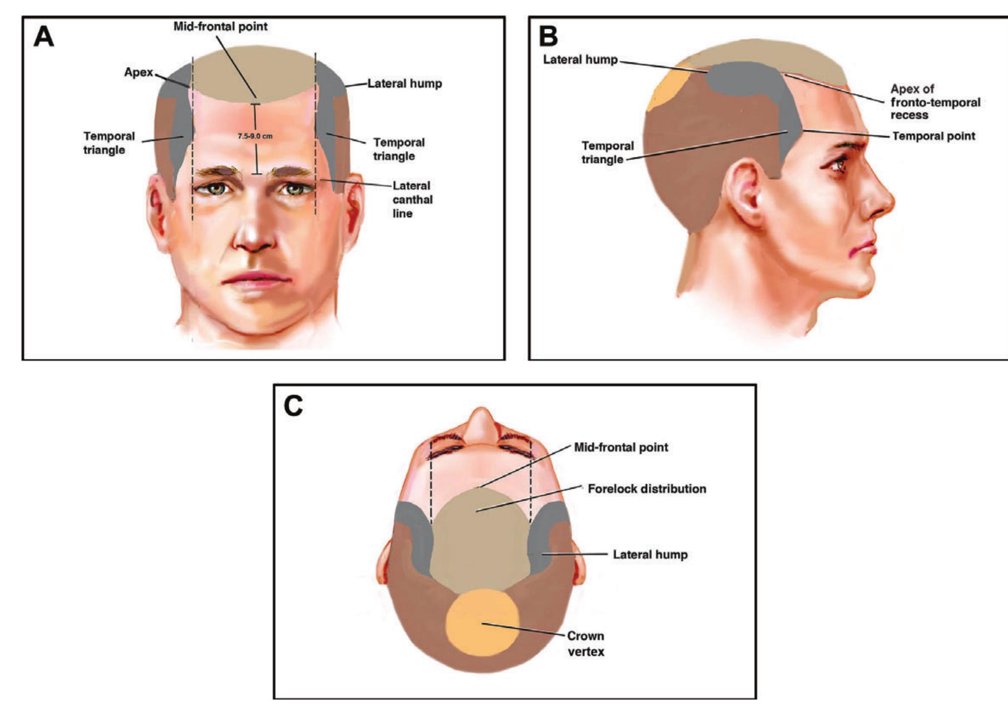 Surgical anatomy of the scalp. (a) frontal view emphasizing