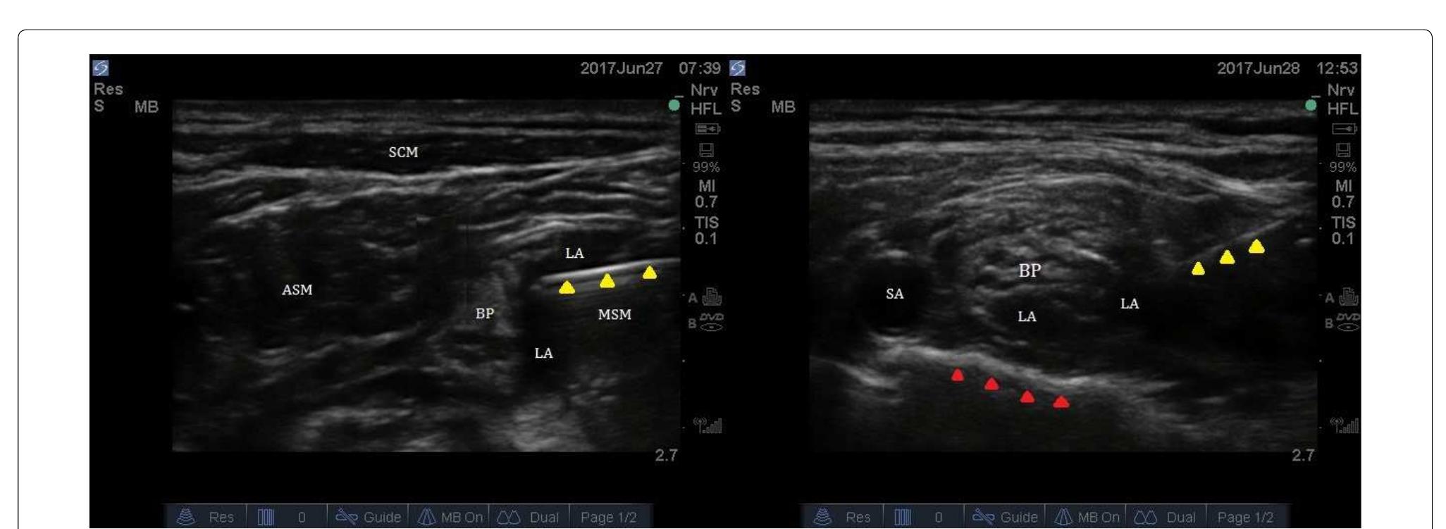 Ultrasound image of the brachial plexus anatomy, needle