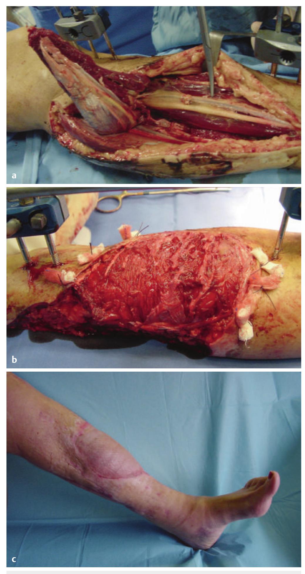 > fig.1 a distal tibial defect with exposed bone from a