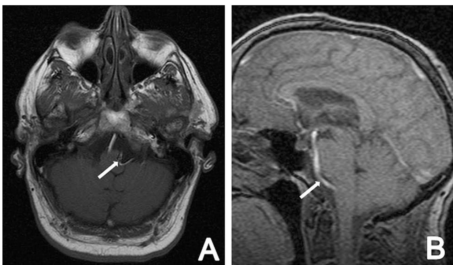 Axial (a) and sagittal (b) brain mri of a 63-year-old man