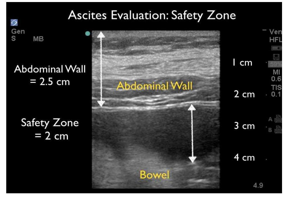 Evaluation for ascites “safety zone”, the ascites filled