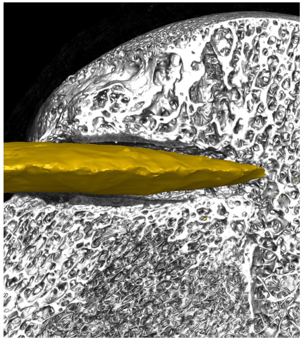 3d-reconstruction of the proximal humerus and the flint