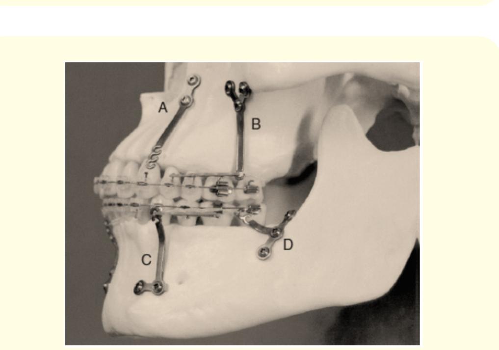 Position of miniplates. a) i-type, b) y-type, c) l-type, d)