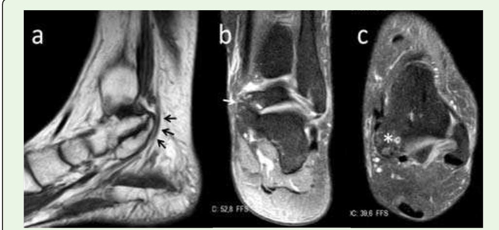 (a) sagittal t1-weighted mri. black arrows show the tibial