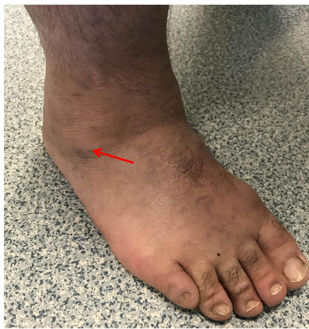 Figure 2 - from Symptomatic os talus secundarius: a case