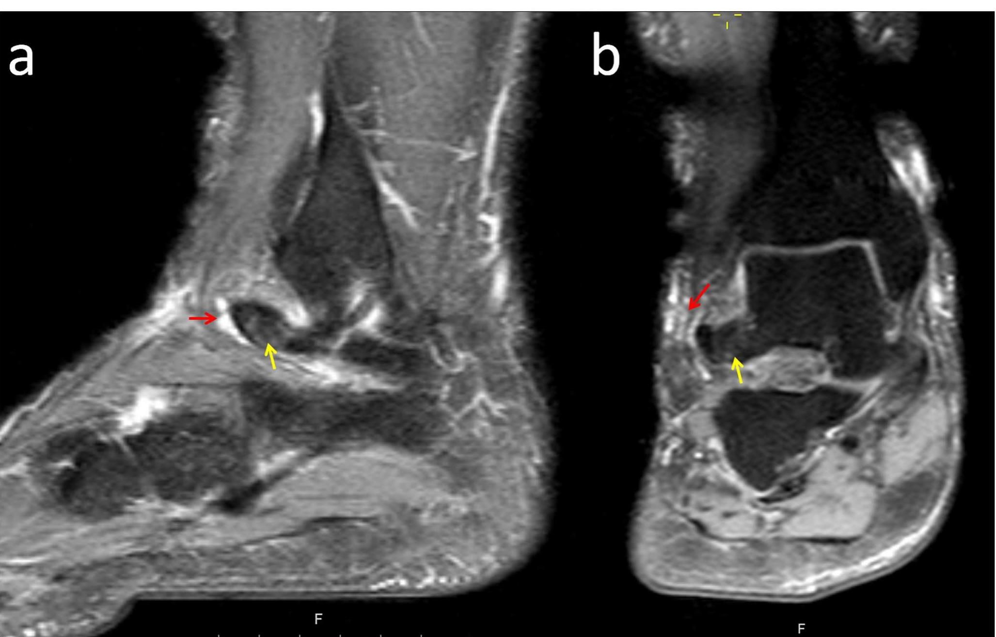 Mri of the foot. a sagittal t2-weighted turbo spin-echo