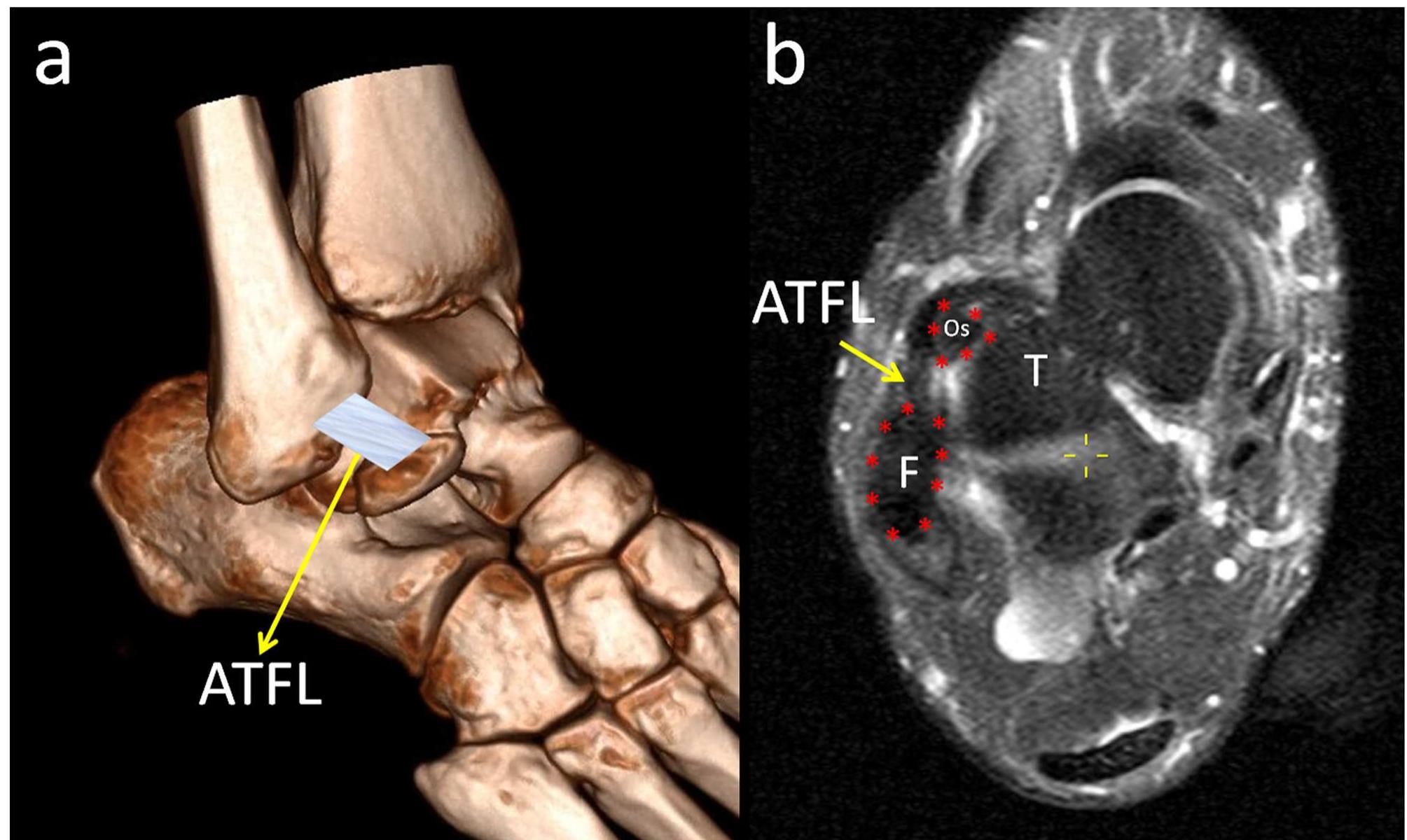 A illustration showing the relation between the ossicle and