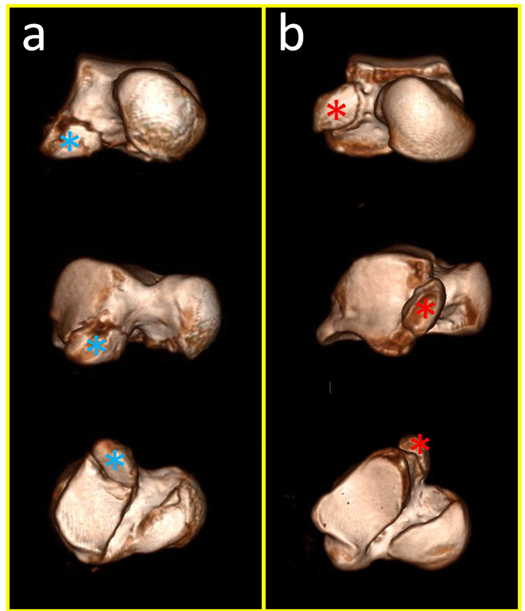 Anterior, lateral, and inferior views of a a fracture of the
