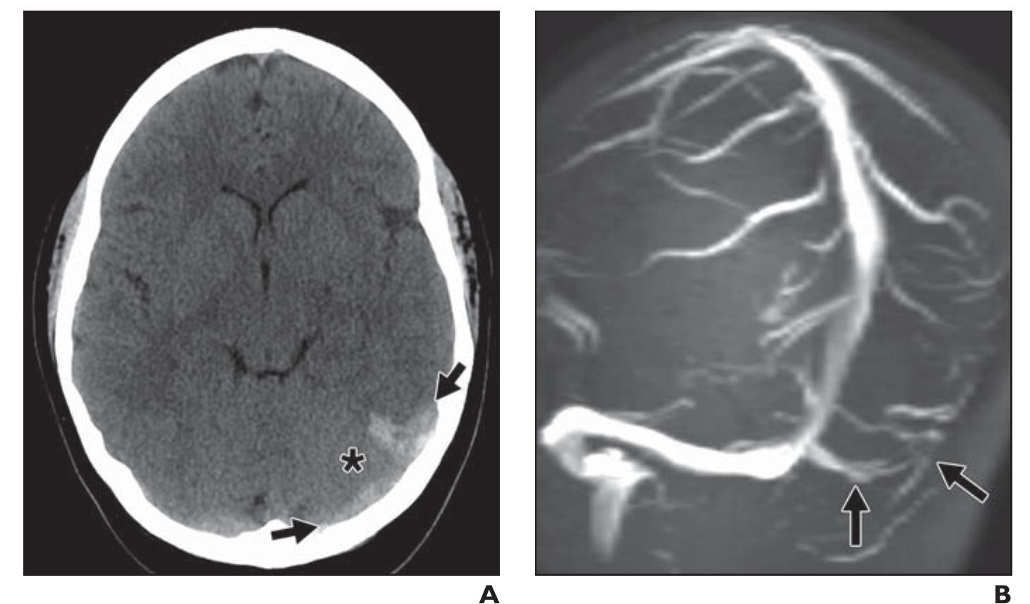 —cerebral venous thrombosis. a, unenhanced ct image shows