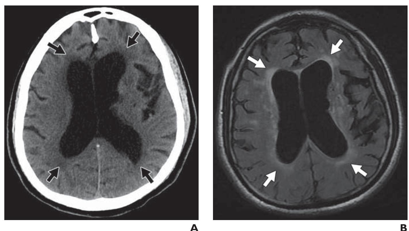 —normal pressure hydrocephalus. a, unenhanced ct image shows