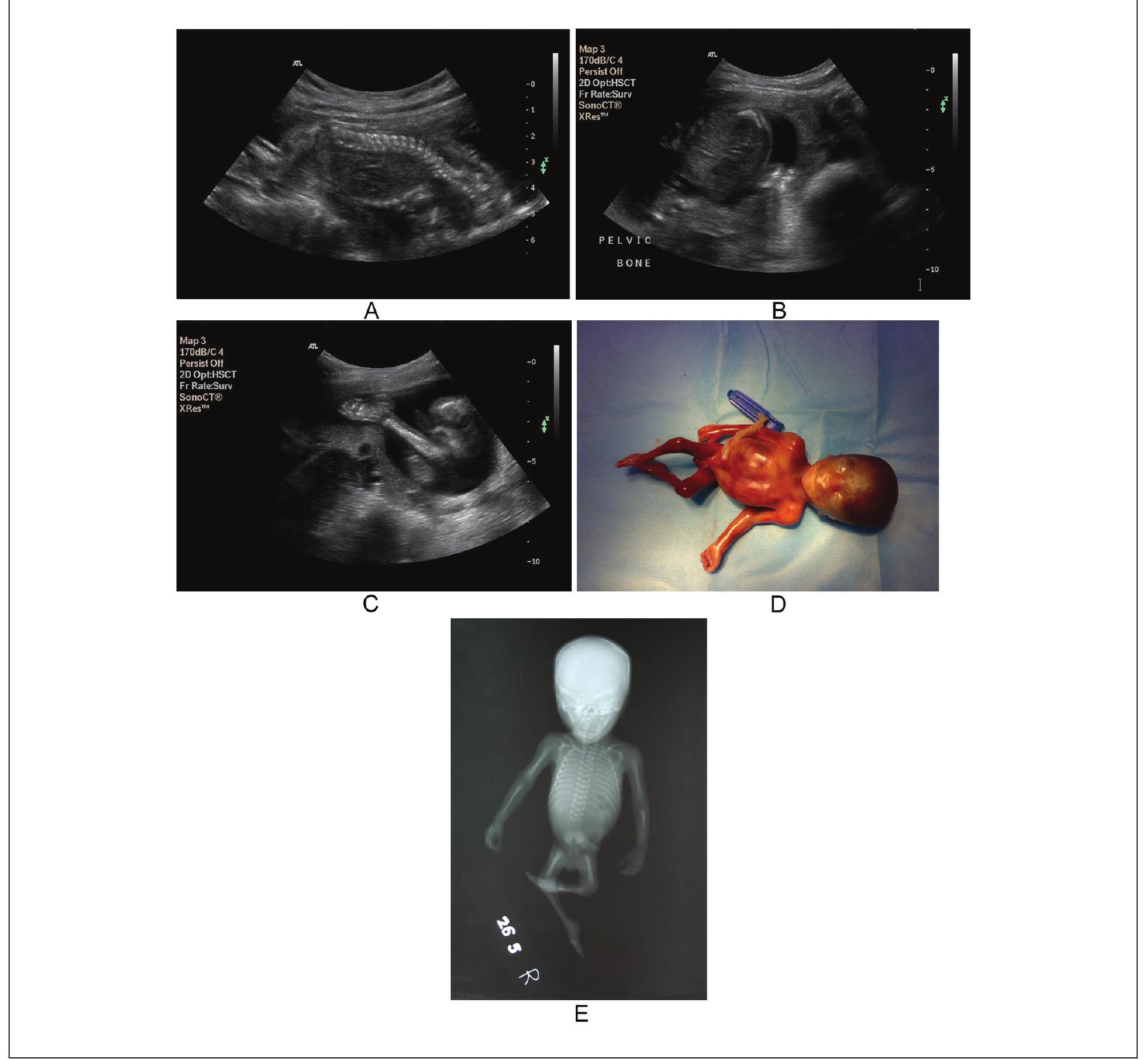 a) antenatal sonographic image in sagittal plane shows