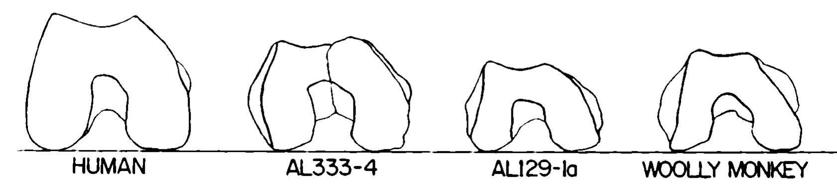 Outline of the distal surface of the femur. lateral! is to