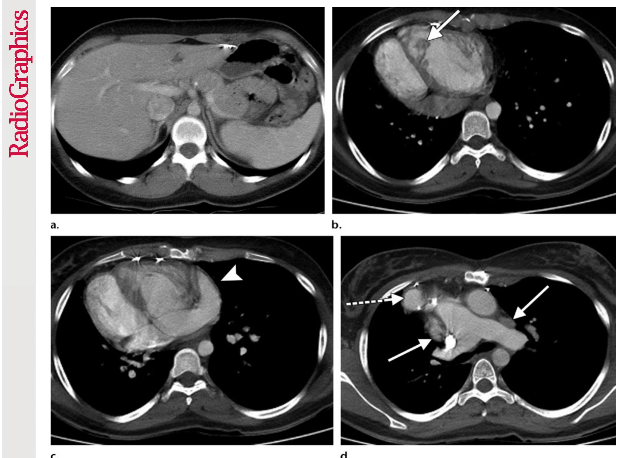 Axial images from thoracic ct angiography show