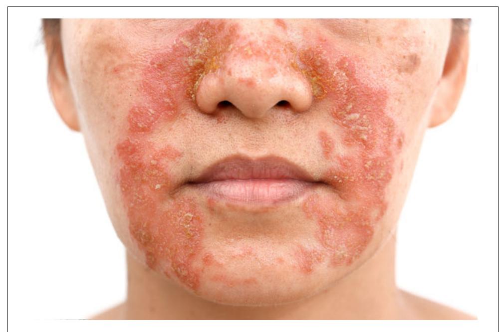 Seborrheic dermatitis: greasy yellow scale with a