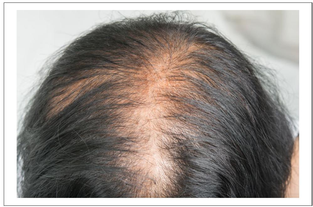 Diffuse alopecia. photo courtesy of srisakorn adobe stock