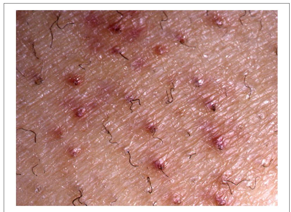 Follicular-based petechiae with corkscrew hairs seen in